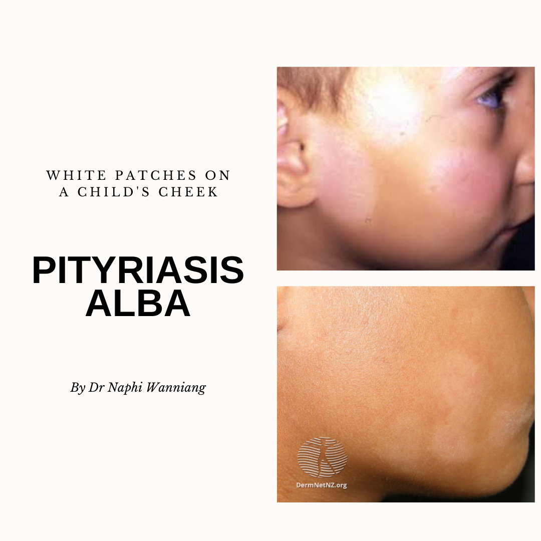 Pityriasis alba | Dr Naphisabet Wanniang