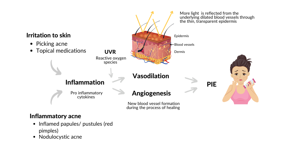 Red scars or Post inflammatory erythema | Dr Naphisabet Wanniang