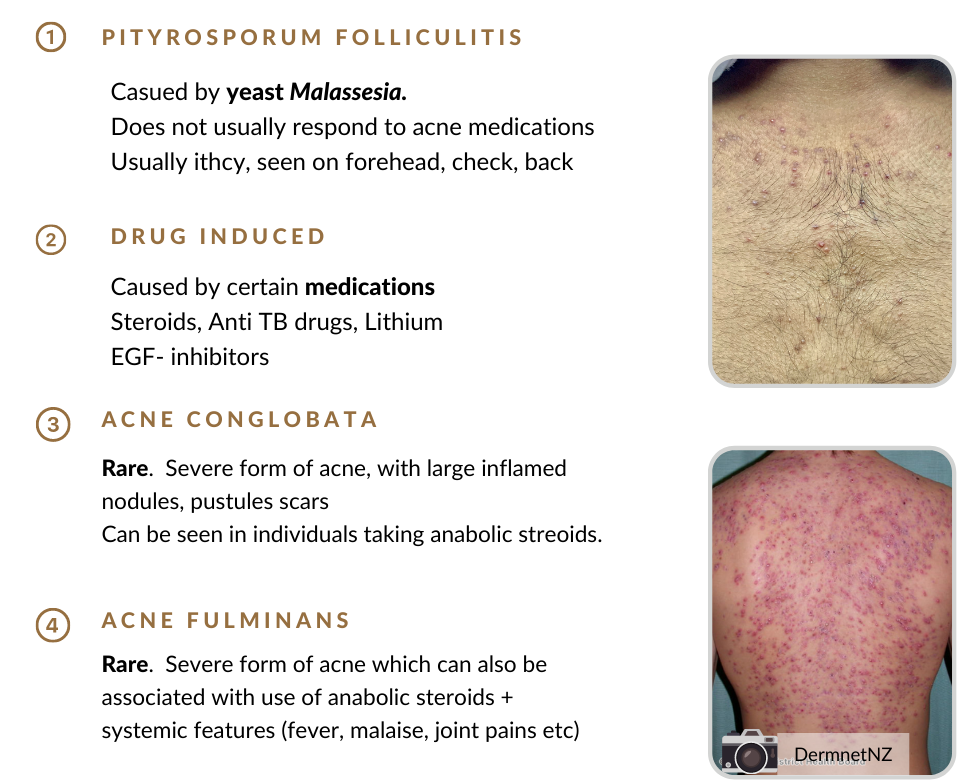 An update on body acne (truncal acne) | Dr Naphisabet Wanniang