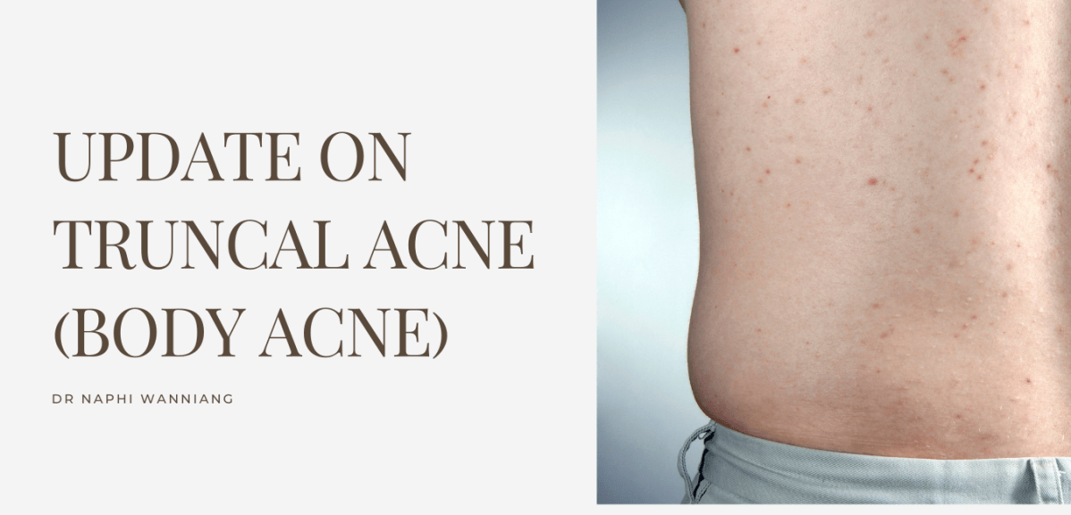 An update on body acne (truncal acne) | Dr Naphisabet Wanniang